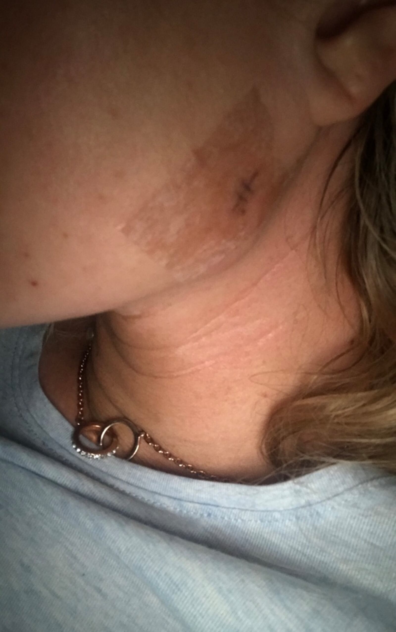 ‘Botched’ dermal filler leaves woman with physical and emotional scars ...