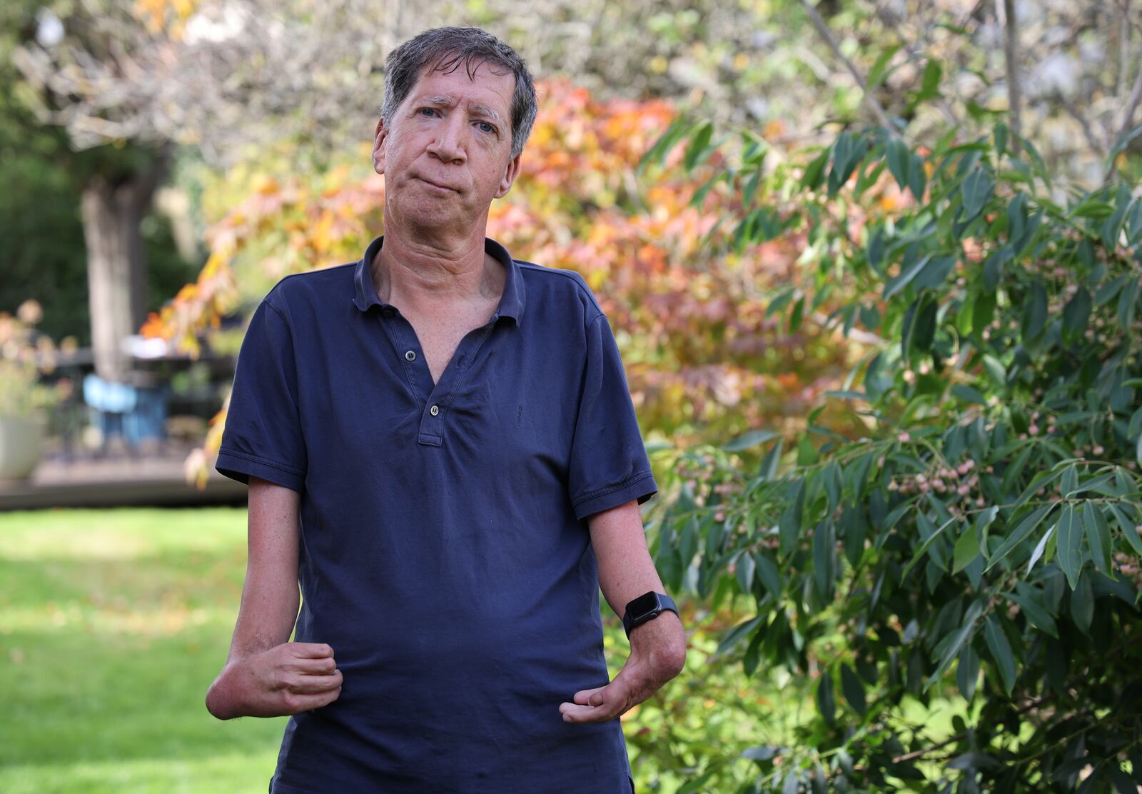 Thalidomide survivors: ‘Having no arms is an unusual disability, there ...